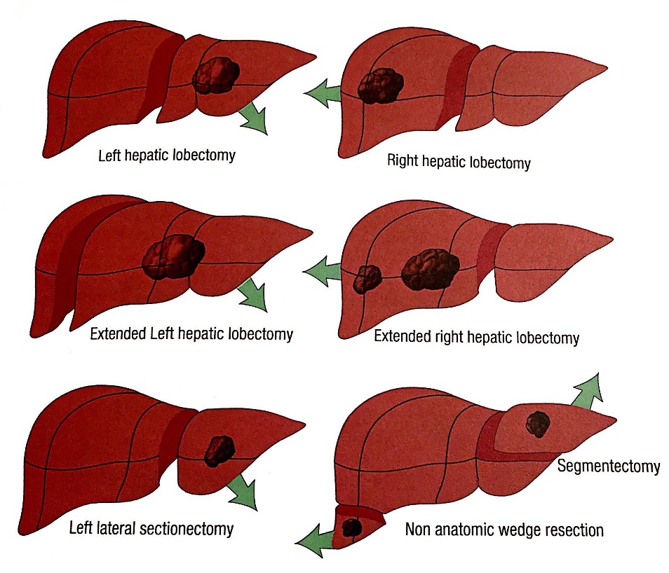 Metástasis hepáticas :: Cirugía Informada